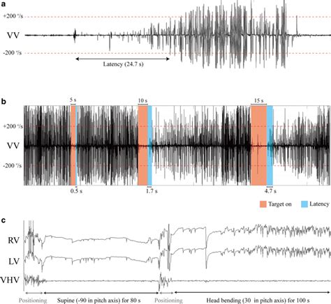 Effect Of Visual Fixation And Downbeat Nystagmus On Ocular Flutter The