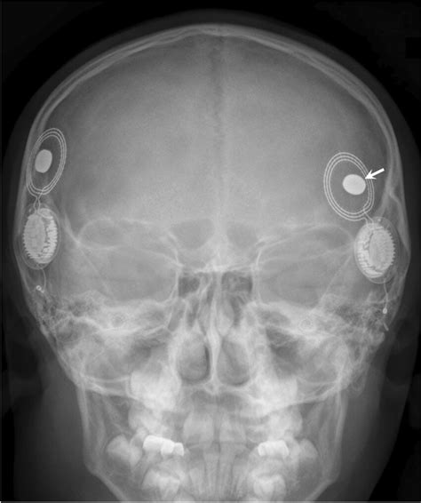 Bilateral Advanced Bionics Advanced Bionics Stäfa Switzerland Hires Download Scientific