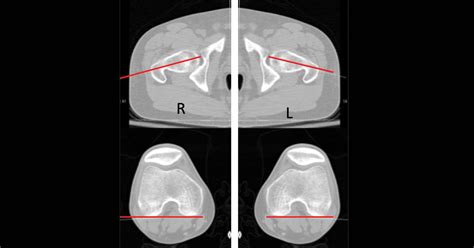 Second Generation Locked Nails Help Avoid Rotational Malalignment In Femur Fractures
