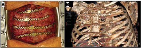Figure 2 From A Double Dacron Patch Repair For Right Ventricle Rupture During Negative Pressure