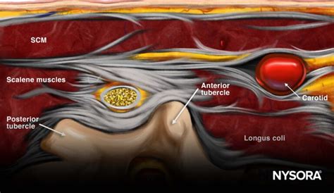 Tips For The Cervical Nerve Root Block Nysora
