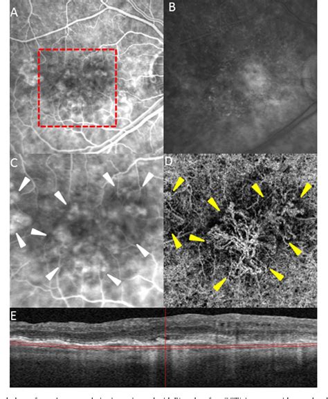Figure 1 From A Comparison Between Optical Coherence Tomography A Comparison Between Optical