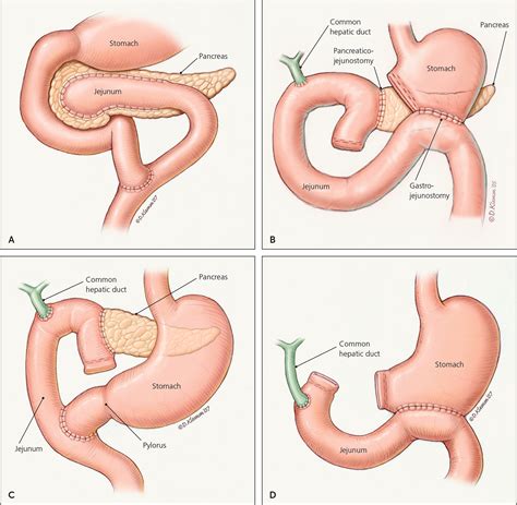 Chronic Pancreatitis Diagnosis And Treatment Aafp