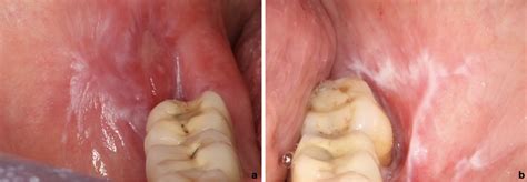 Oral Lichen Planus Opmdcare