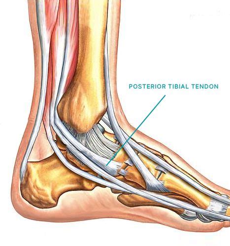 Posterior Tibial Tendon Dysfunction Rebuild