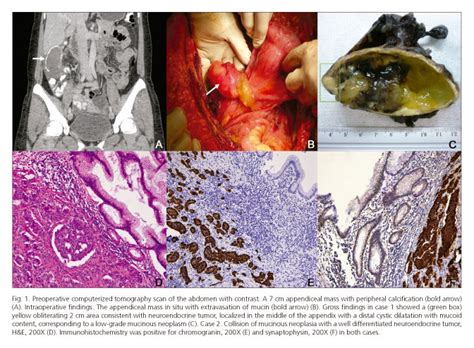 Well Differentiated Neuroendocrine Tumor Of The Appendix And Low Grade