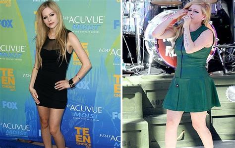 Avril Lavigne Before And After Plastic Surgery Nose Face Boobs