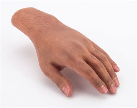 Finger Hand Partial Arms Prosthetic In Miami Fl Finger Prosthetics
