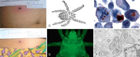 Orientia Tsutsugamushi Scrub Typhus Clinical Tree