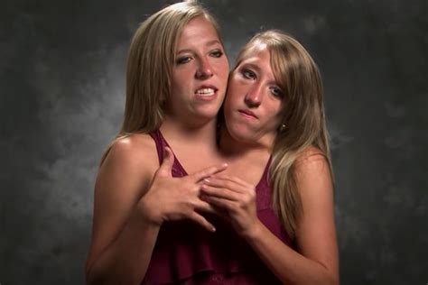 Years After These Siamese Twins Were Born They Shared Shocking News Readbakery
