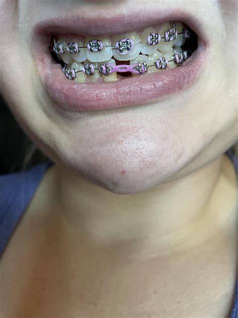 Braces Progress 6 Weeks In Rbraces