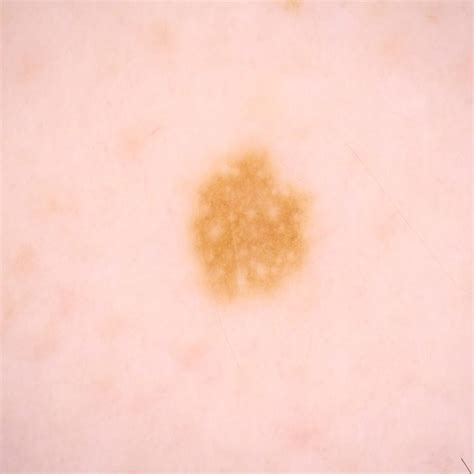 Benign And Malignant Skin Lesion Dataset Kaggle