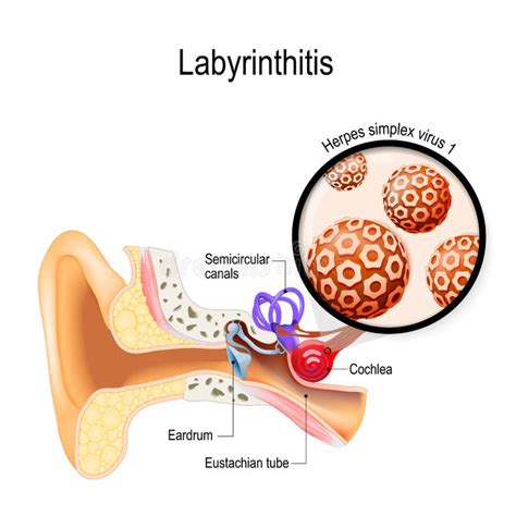 Labyrinthitis Stock Illustrations 37 Labyrinthitis Stock