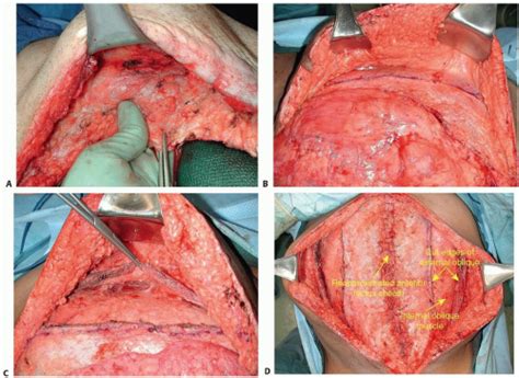 Hernia Repair With Open Component Separation Plastic Surgery Key