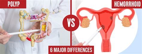 Polyp Vs Hemorrhoid 6 Major Differences Explained