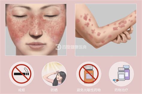 小知识：系统性红斑狼疮 Sle 症状与病因 病友交流