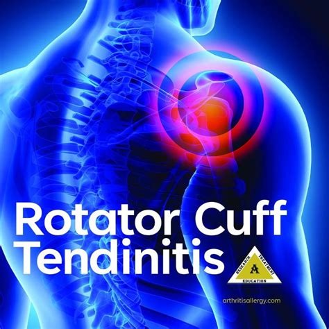 Does Heat Help Rotator Cuff Tendinitis At Marcelene Grant Blog