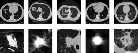 Figure 1 From Evaluate The Malignancy Of Pulmonary Nodules Using The 3 D Deep Leaky Noisy Or