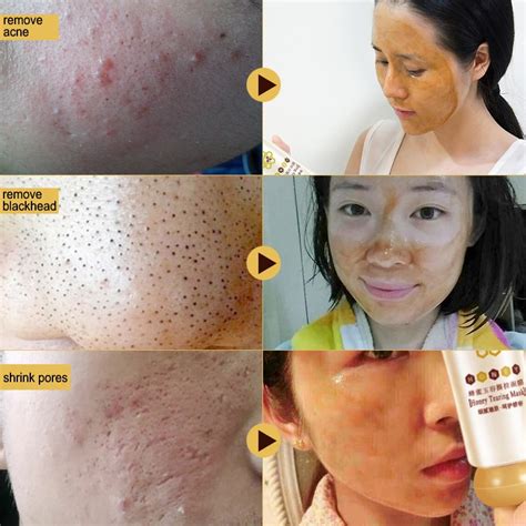 Мед разрывающая маска для лица глубокая очищающая черные точки для удаления акне контроль