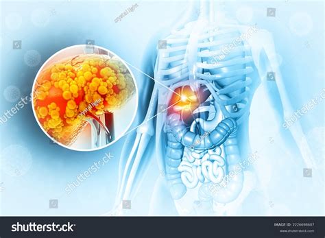Liver Cirrhosis Liver Disease 3d Illustration Stock Illustration 2226698607 Shutterstock