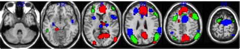 Figure 1 From The Salience Network Is Responsible For Switching Between The Default Mode Network