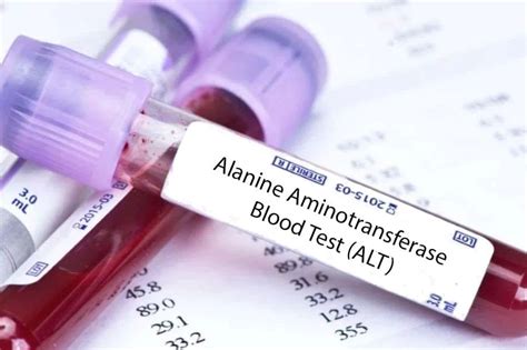 Alanine Transaminase Alt Potential Sources Of Error In Your Lab Result Lab2docs Magazine