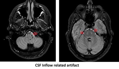Flow Artifact Mri Csf Flow Artifact