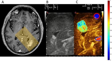 Qualitative View Of Microbubble Density In Selected Regions In A Case