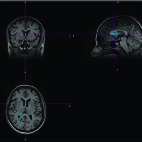 Segmented Choroid Plexuses In Brainmagix Software Download Scientific Diagram