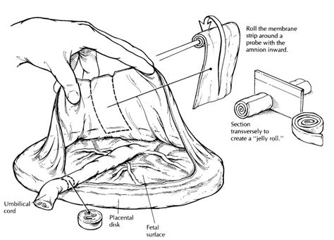 Products Of Conception Surgical Pathology Dissection