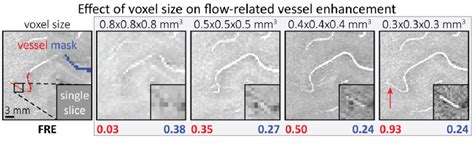 effect of voxel size on flow related vessel enhancement thin axial
