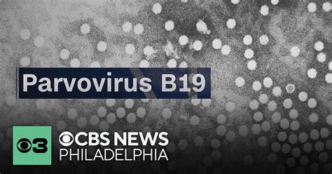Cdc Issues New Warning About Increasing Cases Of Parvovirus B19 Cbs