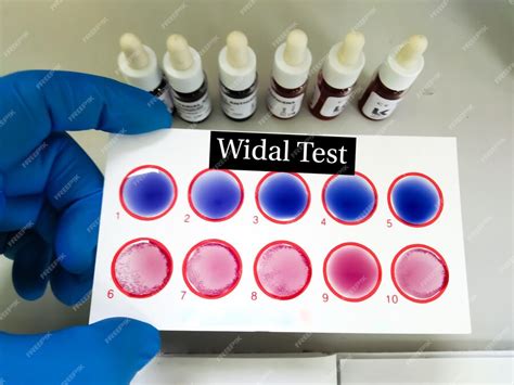 Premium Photo Scientist Hold Testing Plate For Widal Test By