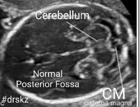 Magna Cisterna Magna Symptoms At Terry Summers Blog