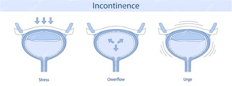 Premium Vector Anatomy Of The Bladder Diagram Of Types Of Urinary Incontinence Vector