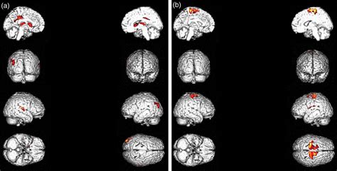 Brain Positron Emission Tomography In Idiopathic Normal Pres Nuclear Medicine Communications