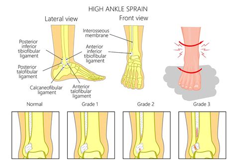High Ankle Sprain Recovery Time