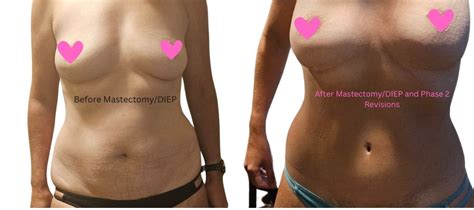 Breast Reconstruction Options After Or During Mastectomy Bra Society