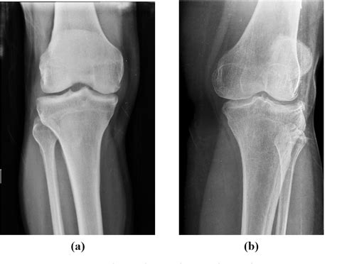 Table 1 From A Decision Support System For Osteoporosis Risk Prediction Using Machine Learning