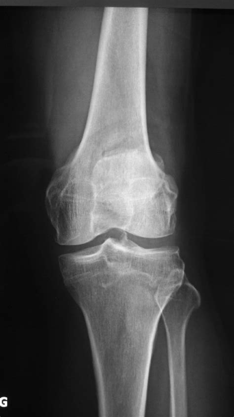 Bicompartmental Knee Makoplasty Robotic Partial Knee Replacement Hc