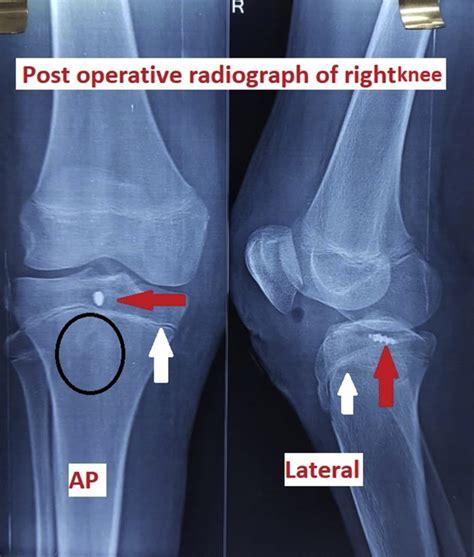 All Inside Anterior Cruciate Ligament Tibial Avulsion Repair Pmc