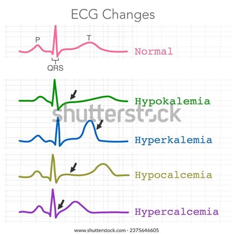 Hypercalcemia Ecg