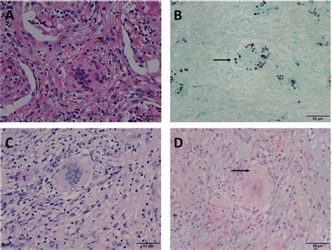 Cryptococcus Histology