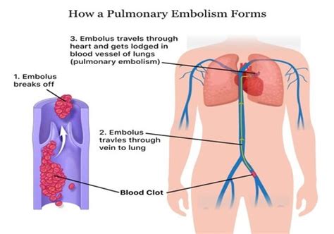 Hypercoagulable Disorders Flashcards Quizlet