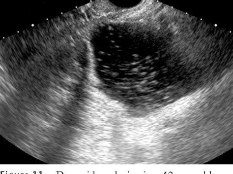 Ovarian Thecoma Ultrasound