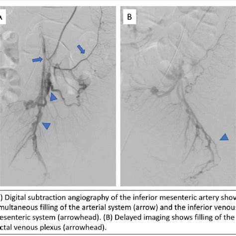 Left Sided Colitis Orange Arrow Extending From Splenic Flexure To The