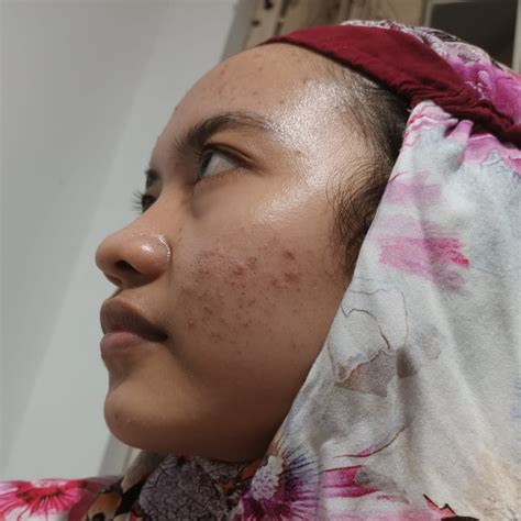 Jenis Jerawat Object Detection Dataset And Pre Trained Model By Bri Institute