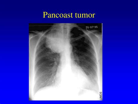 Ppt Tumors Of The Lung And Upper Respiratory Tract Powerpoint