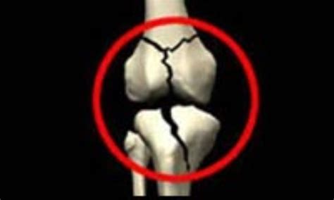 کمبود ویتامین کا K و تأثیر آن بر سلامت استخوان