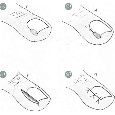 Illustration Of Winograd Technique A Appearance Of Ingrown Nail B Download Scientific